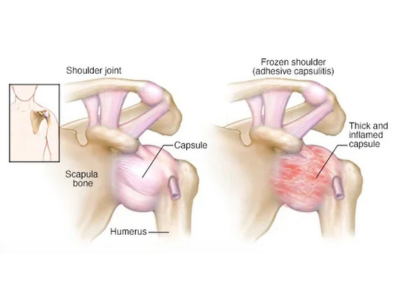 Frozen Shoulder Injury Surgery In Ahmedabad/Gujarat - Dr Karnav Panchal