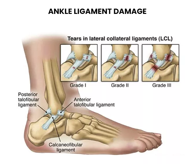 Acute & Chronic ATFL Tears Treatment in Ahmedabad/Gujarat - Dr Karnav ...